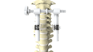 SURE To Showcase Open And Mini open Sterile And Single use Retractor SURE To Showcase Open And Mini open Sterile And Single use Retractor